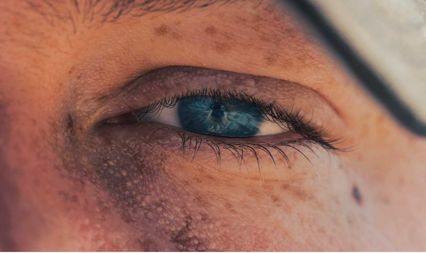 Treating Dark Eye Circles with Melarase Brightening Kit - Kare MD Skin ...